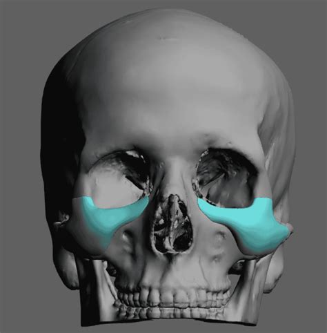 How Can My Negative Orbital Vector And Sagging Lower Eyelids Be Fixed