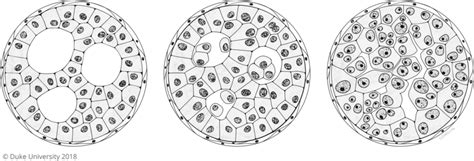 Examples Of Ductal Carcinoma In Situ Based On Nuclear Grade