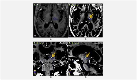 Linac Ablative Techniques Used To Target Tremor Vanderbilt Discover