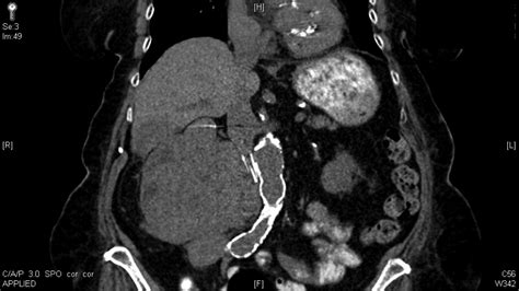A Case Of Primary Renal Lymphoma Urology