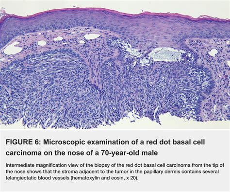 Figure 10 From Red Dot Basal Cell Carcinoma Report Of Cases And Review