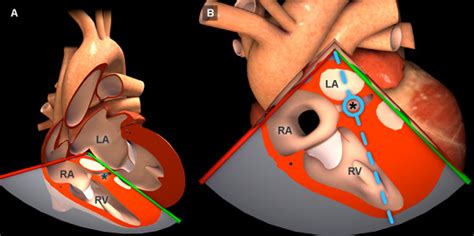Virtual Tee Using Spectral Doppler To Evaluate The Coronary Sinus