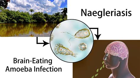 Explainer Everything To Know About Brain Eating Amoeba Thats