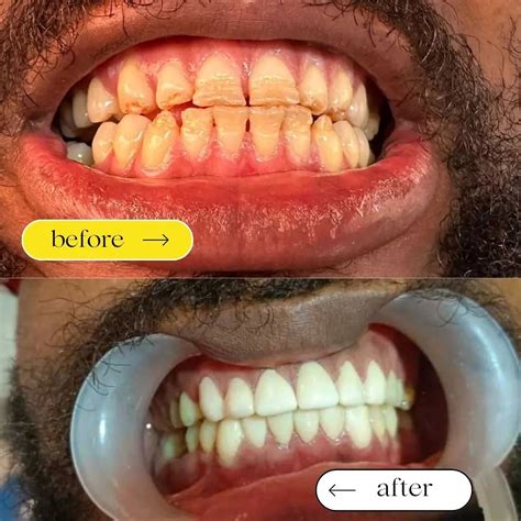 Fix Stained Chipped Or Misaligned Teeth With Veneers Today Health