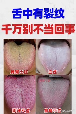 舌头上有裂纹，或是多种疾病征兆！