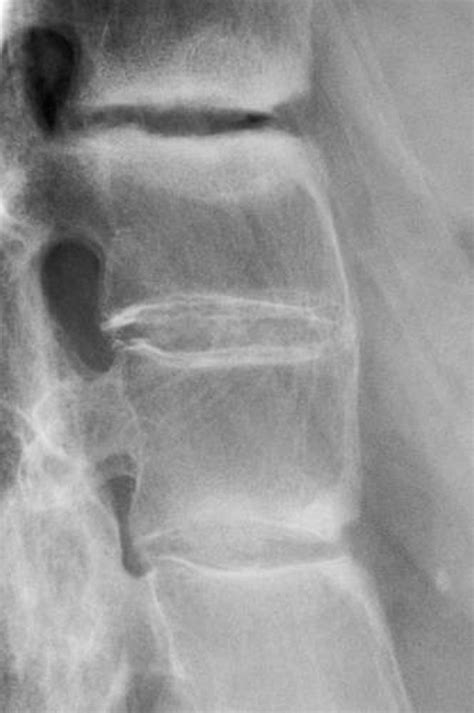 Imageespondilitis Anquilosante Manual Msd Versión Para Profesionales