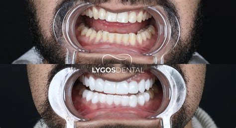 Zirconia Crown Dental Crown In Turkey Lygs Dental 2024