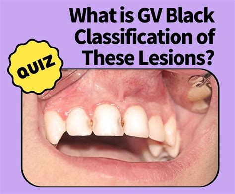 Identify The Gv Black Classification Medizzy