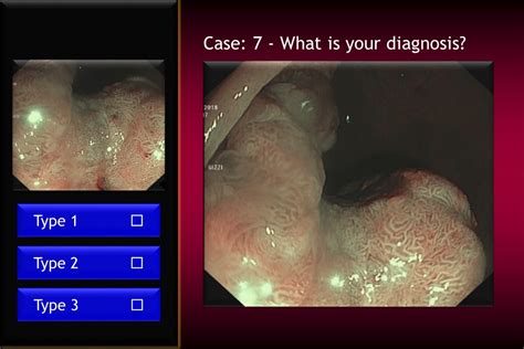 Nice Classification Colon Explorer