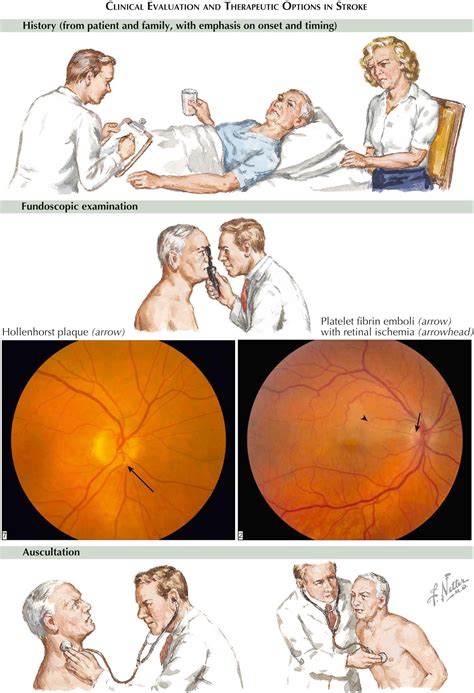 Cerebrovascular Circulation And Stroke Clinical Tree