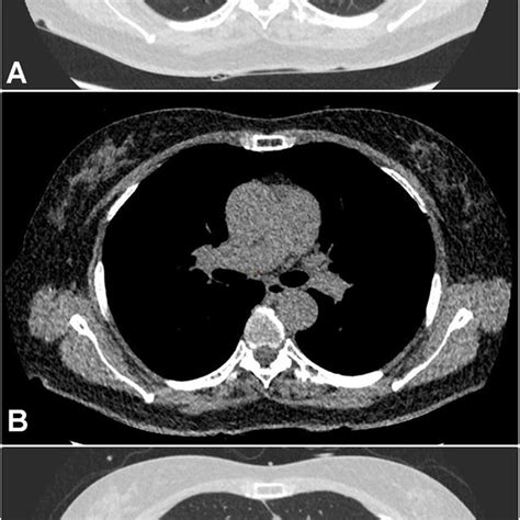 An Example Of Subsolid Nodule With An Air Bronchogram Sign According To
