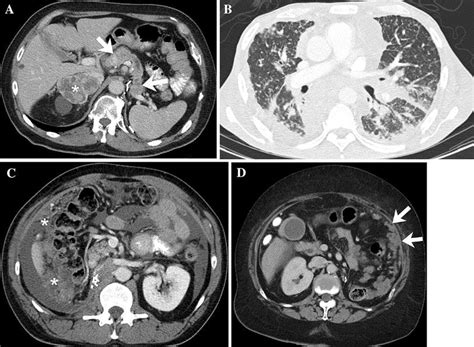 Metastasis In Renal Cell Carcinoma Rcc A Axial Contrast Enhanced Ct