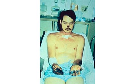 Peste Bubónica Qué Es Y Síntomas