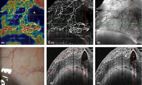 Filtering Bleb Function At Kenton Williams Blog