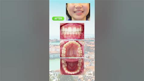 『八重歯が気になる。』 Sex Women Before 11歳10か月 After 13歳6か月 矯正治療期間 1年9か月 矯正治療費 929500円 1か月あたり 44262円 上下