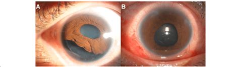 Preoperative And Postoperative Slit Lamp Photographs Of Iridodialysis