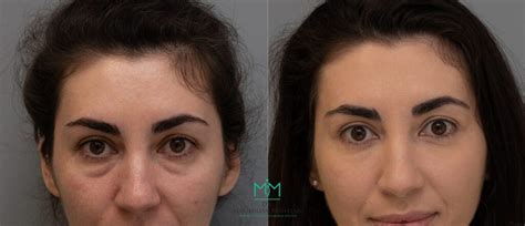 Blefaroplastie Dr Maximilian Muntean Chirurgie Estetica