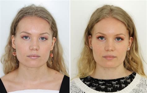 I Took Botox For Bruxism And It Was So Worth It