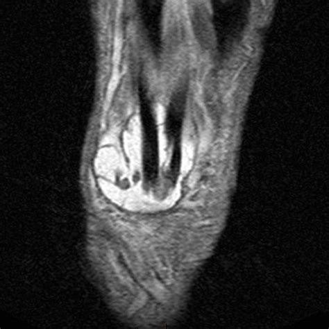 Stenosing Tenosynovitis Of The 4th Extensor Compartment Radsource