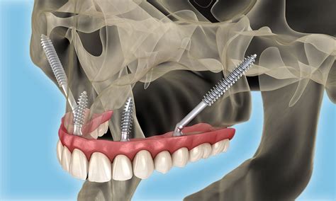 Zygoma Implants A Revolutionary Solution For Severe Bone Loss Dr