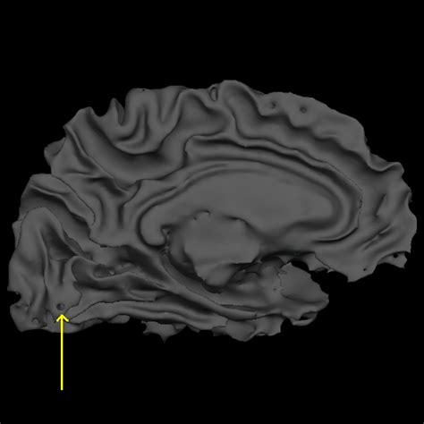 Fstutorialtopologicaldefectv60 Free Surfer Wiki
