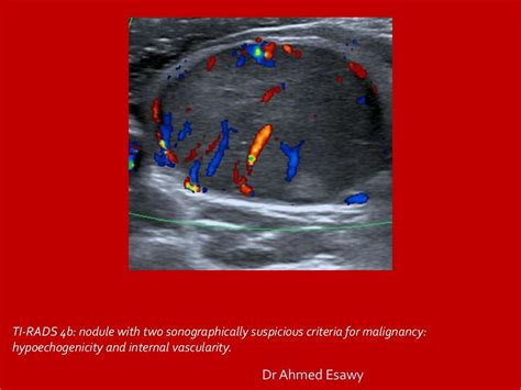 Tirads Thyroid Nodule Imaging Reporting And Data System Dr Ahmed E…
