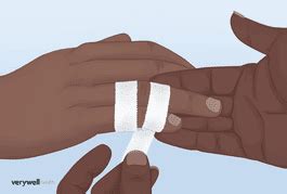 When Can A Severed Finger Be Reattached