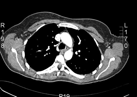 What Does Lung Scarring Look Like On Ct Scan Ct Scan Machine Imaging
