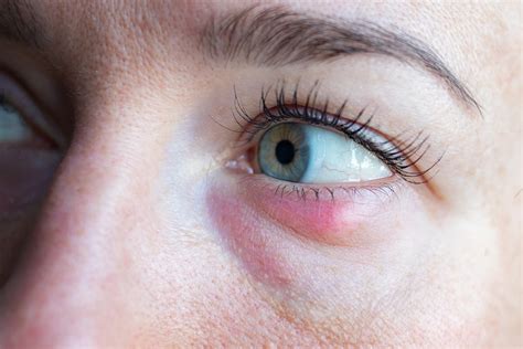 Home Remedies For An Eye Stye Emerald Point Eye Care