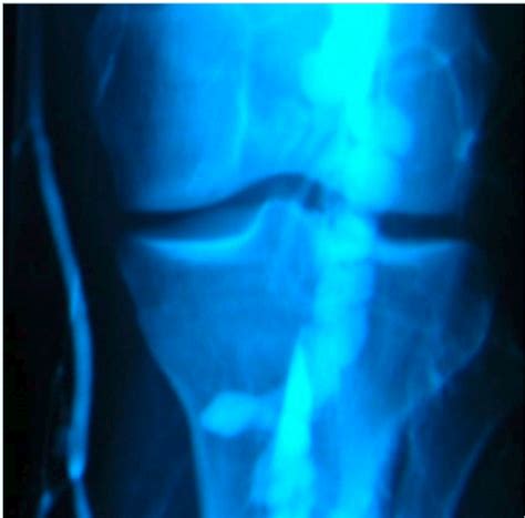 Popliteal Compression Syndrome Servier Phlebolymphologyservier Phlebolymphology