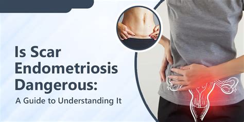 Is Scar Endometriosis Dangerous A Guide To Understanding It