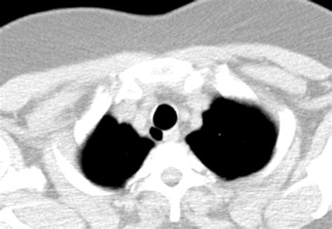 Tracheal Diverticulum Pacs