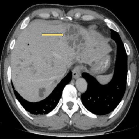 Arrows Showing Extra Biliary Contrast Suggestive Of Hepatic Abscesses