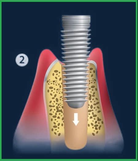 Implantes Dentales Daganzo Clínica Dental Sl
