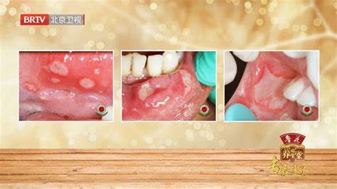 《养生堂》20230320世界口腔健康日——小口疮大隐患北京时间