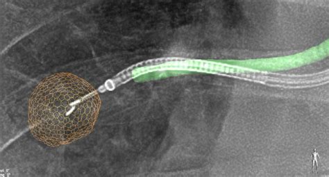 Abdul Hamid Alraiyes Md Fccp On Linkedin Ion Conebeamct Toolinlesion