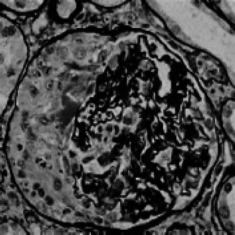 C Anca Pattern Cytoplasmic Type Of Immunofluorescence Download