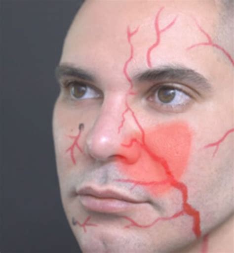 Toxin And Filler Complications Masterclass Interface Aesthetics