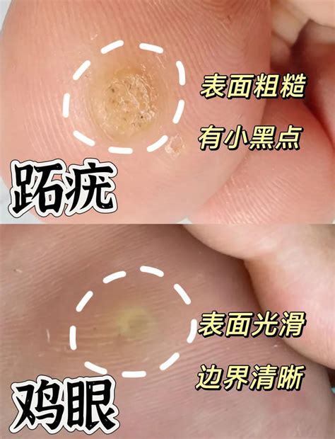 跖疣与鸡眼的区别