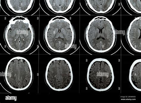 Multi Slice Ct Scan Of The Brain Showing Large Brain Stem And Right