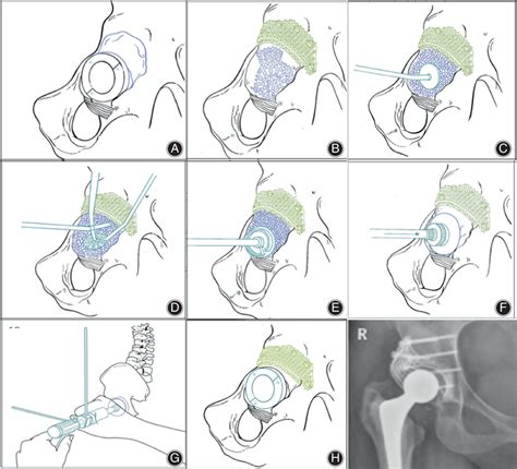 A H The Manual Sketch Of Critical Procedures Of The Ibg Technique Download Scientific