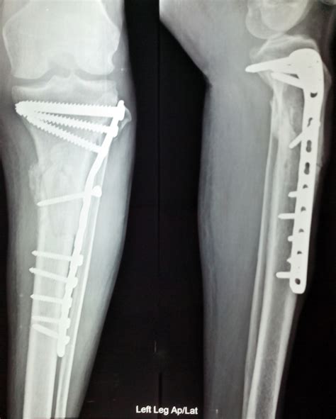 Fracture Fixation Skeletal Fixation