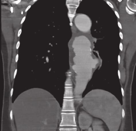 Computed Tomography Demonstrating Multiple Saccular Aneurysms Along The