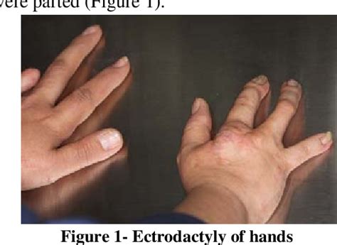 Figure 3 From Ectrodactyly Ectodermal Dysplasia Clefting Syndrome Report Of A Case With Oral