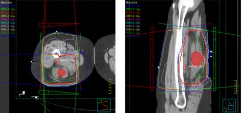 Effect Of Wedges Blocking Filters And Beam Configuration