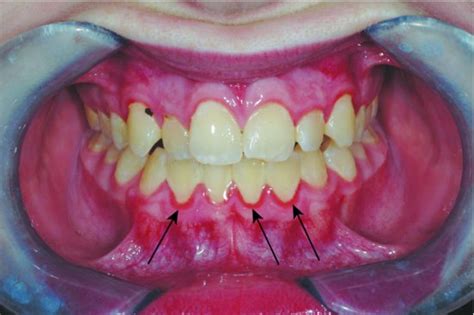 3 Chronic Gingivitis Pocket Dentistry