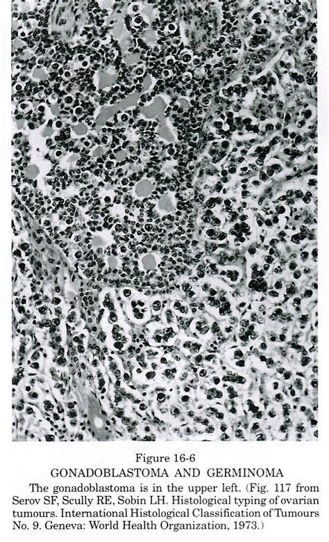 Pathology Outlines Gonadoblastoma