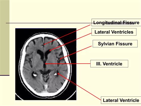 Rbrain Ct Anatomy 1 Ppt