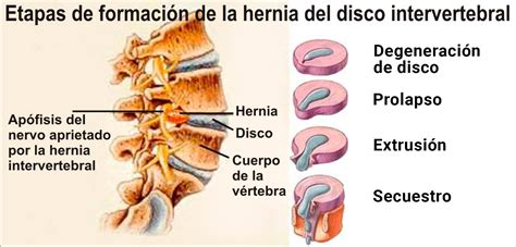 Hernia Discal Qué Es Causas Y Tipos De Lesiones Del Disco