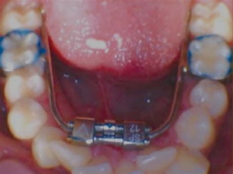 Management Of Transverse Constriction Malocclusions In Adolescents Aos Institute